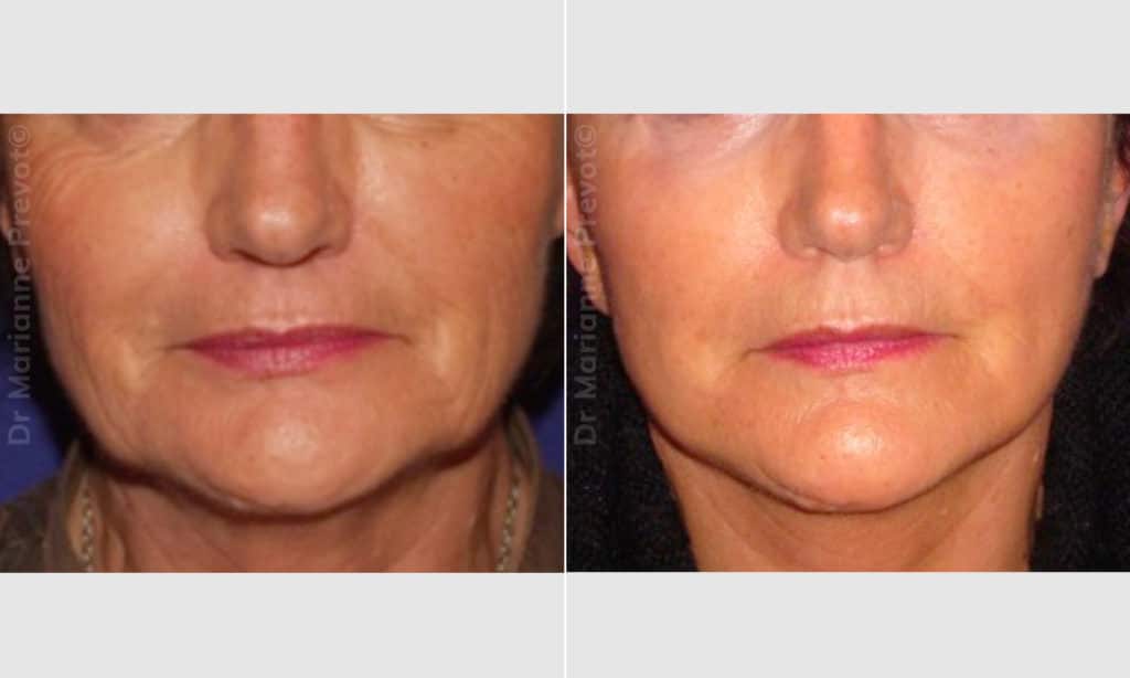 Lifting à Genève - Dr Prevot, Chirugie Esthétique & Réparatrice